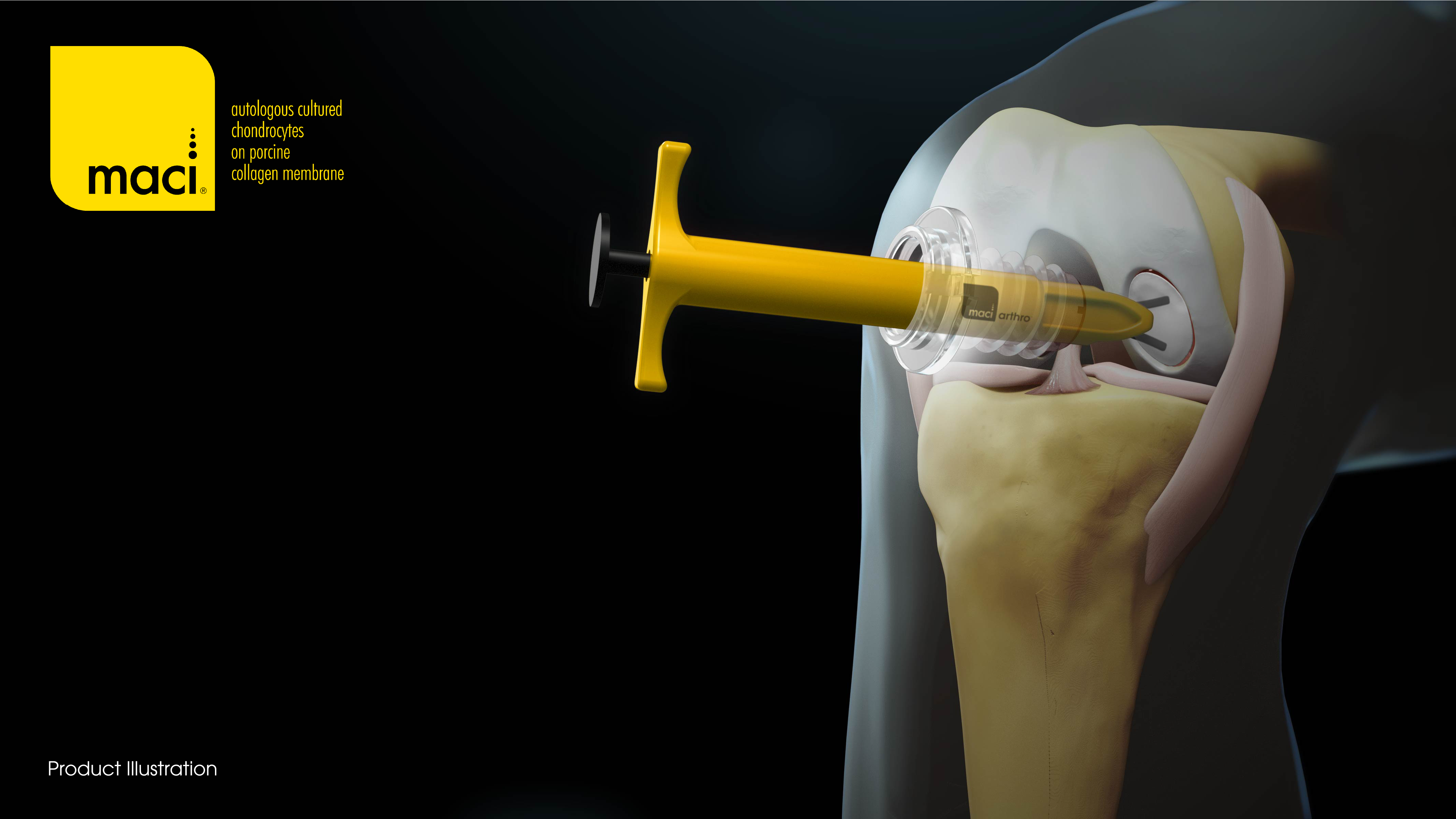 Media Resources - MACI Arthro Surgical Image